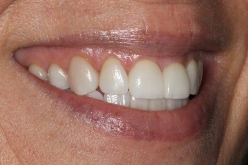 Full Mouth Rehabilitation with Porcelain Crowns and Porcelain Veneers ...