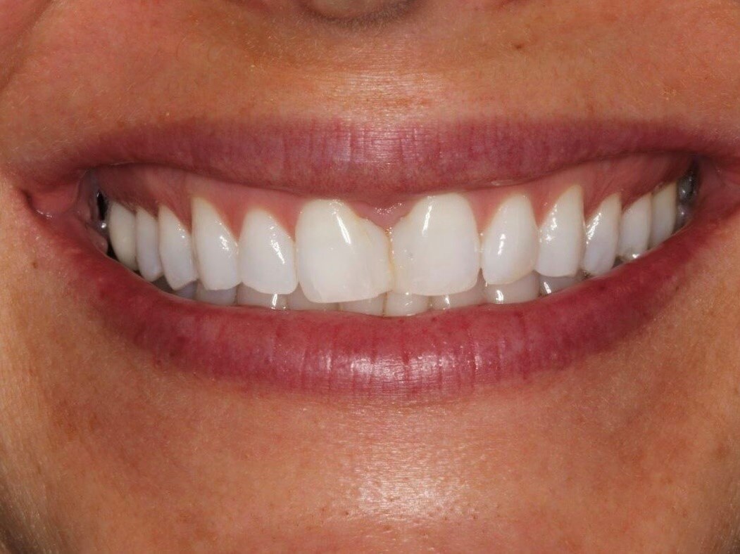 Smile Makeover with Porcelain Veneers, Female, Gilbert, AZ